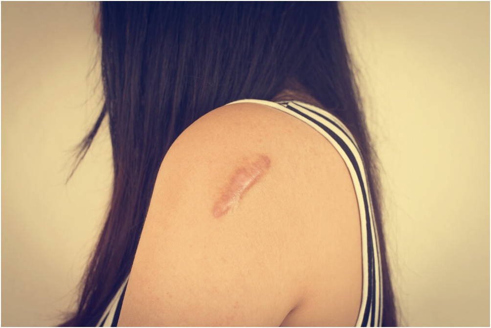SCARS AND YOUR SKIN | Health Library